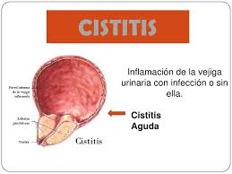 Las cistitis, prevención y tratamiento con Medicina Integrativa ...